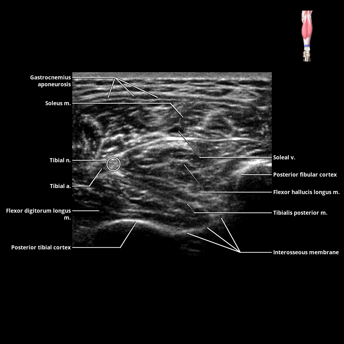 Leg Muscles | Radiology Key