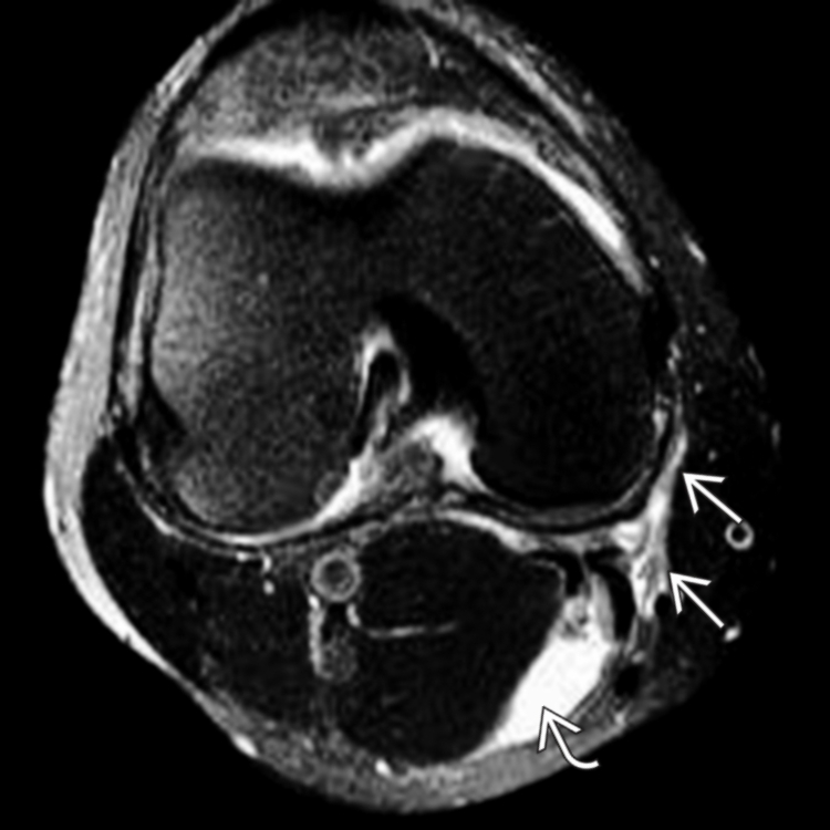 Baker Cyst | Radiology Key