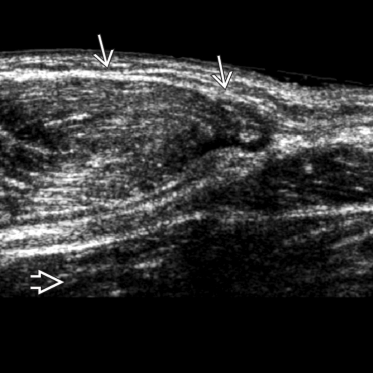 Muscle Injury Radiology Key