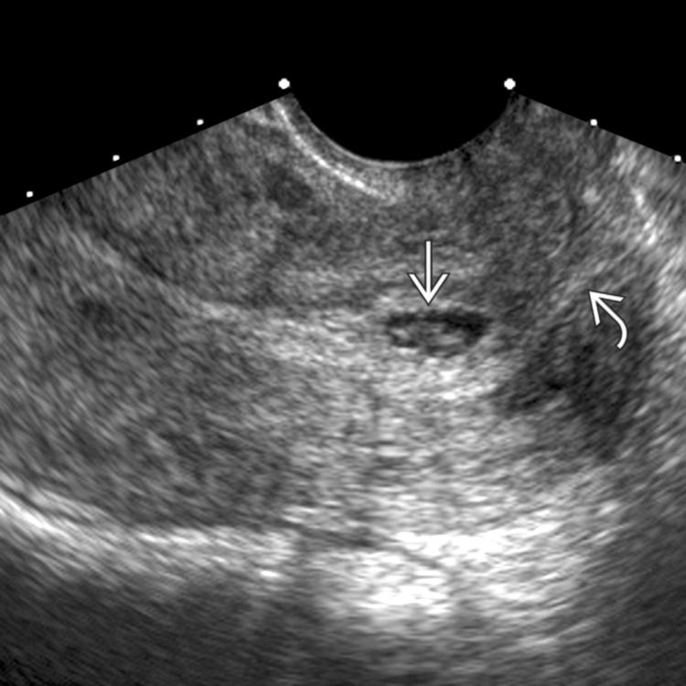 Abnormal and Failed First-Trimester Pregnancy | Radiology Key