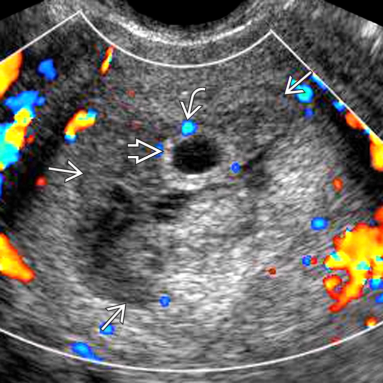 Perigestational Hemorrhage | Radiology Key