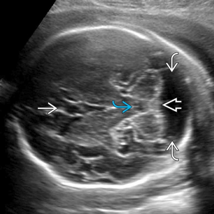 Mega Cisterna Magna | Radiology Key