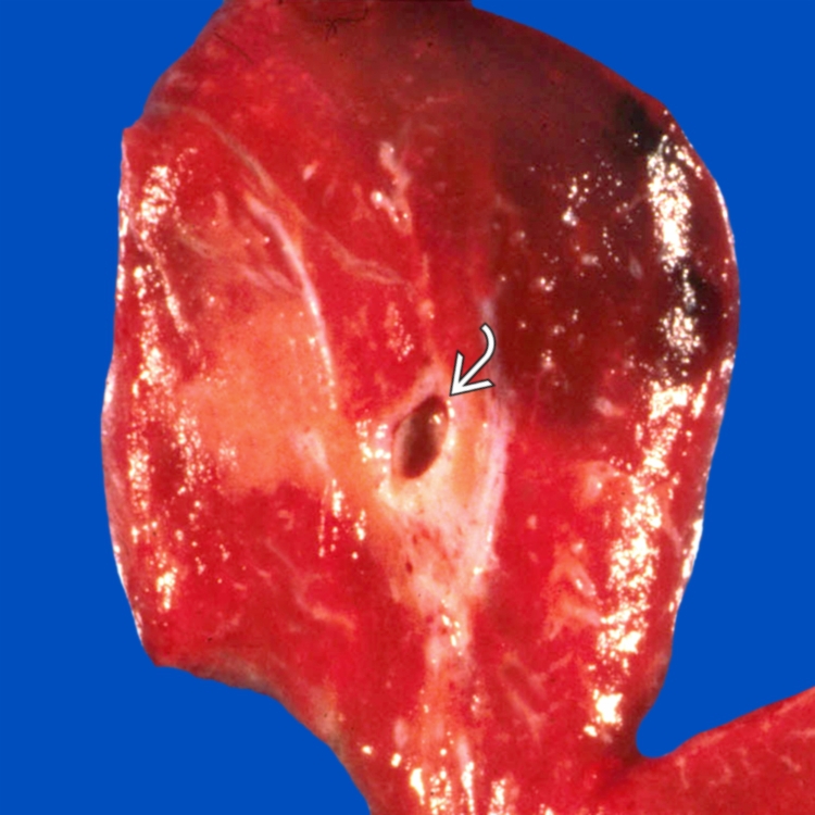 Bronchopulmonary Sequestration (BPS) | Radiology Key