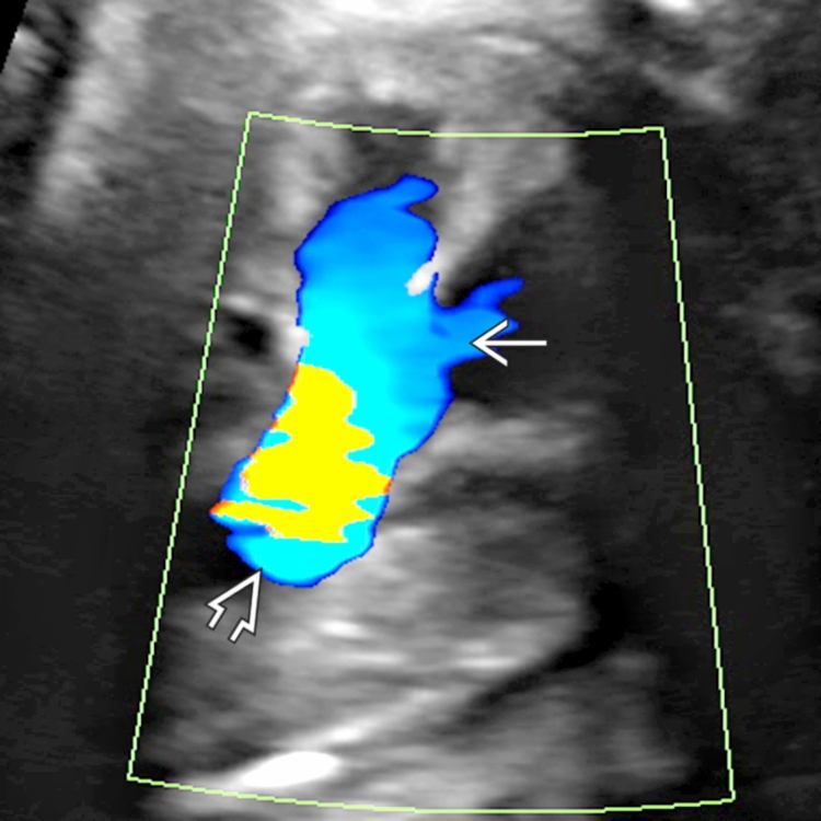Ventricular Septal Defect | Radiology Key