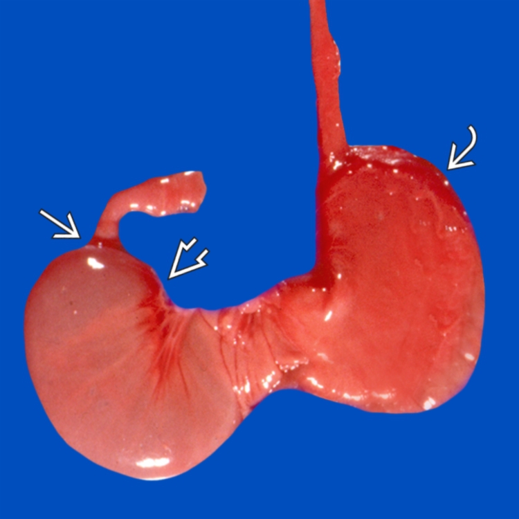 Duodenal Atresia | Radiology Key