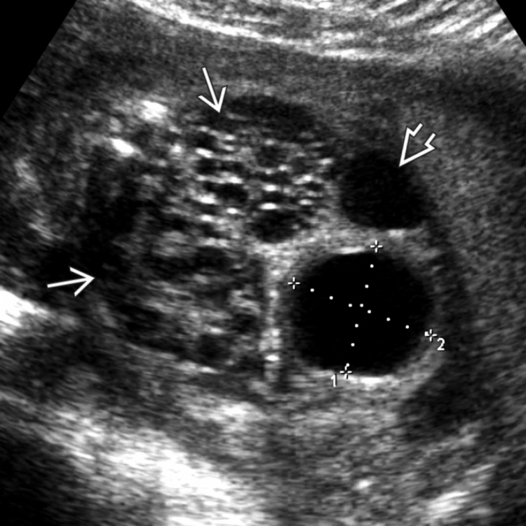 Obstructive Renal Dysplasia | Radiology Key