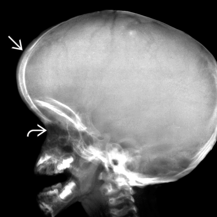 Achondroplasia X Ray Vs Normal Whiplash X Ray Films Levin And