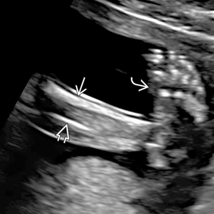 Clubfoot and Rocker-Bottom Foot | Radiology Key
