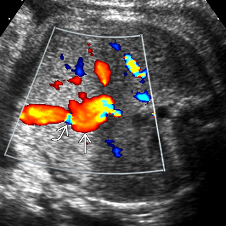 Umbilical Vein Varix | Radiology Key