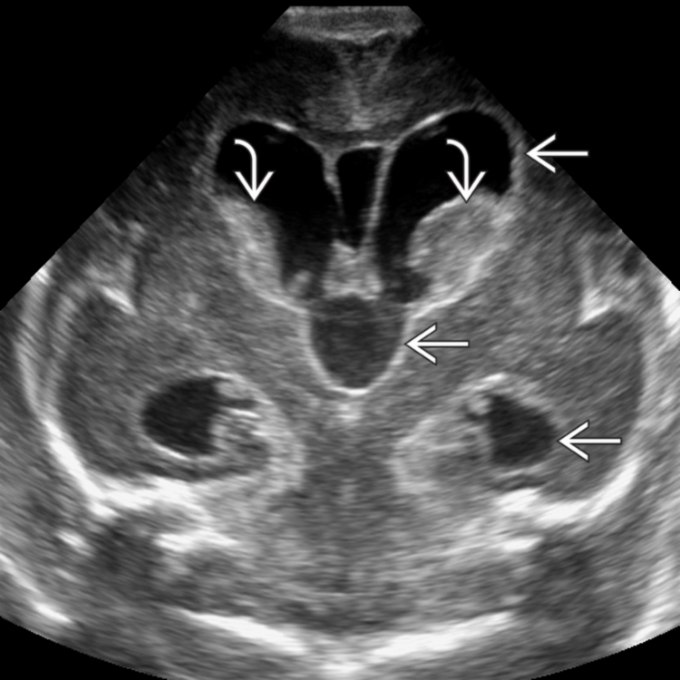 Twin-Twin Transfusion Syndrome | Radiology Key