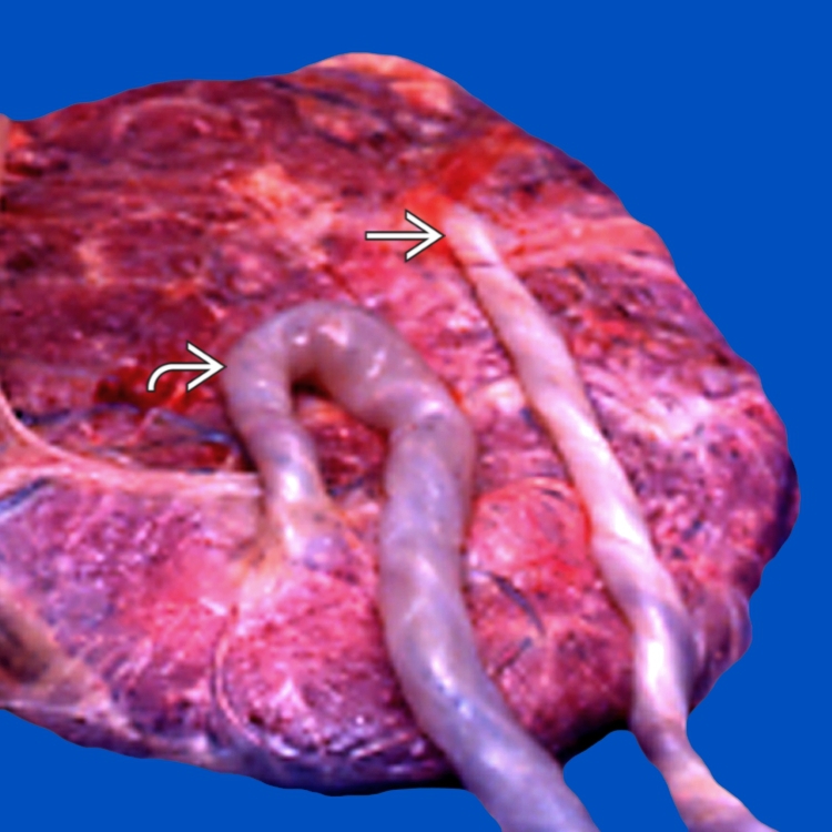 Discordant Twin Growth | Radiology Key