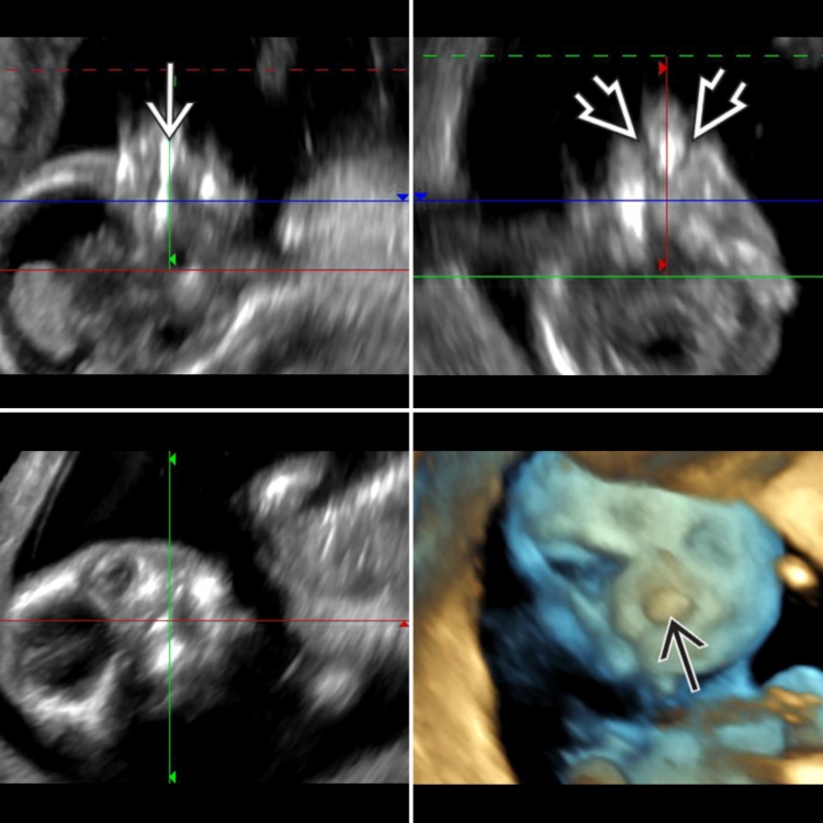 Trisomy 13 | Radiology Key