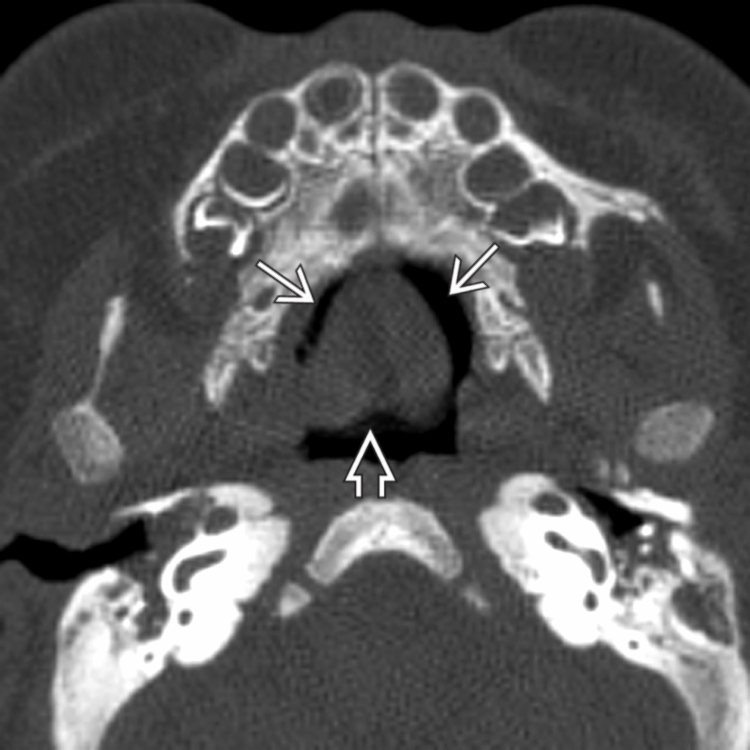 Pierre Robin Sequence | Radiology Key