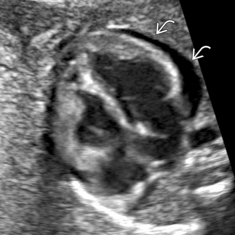 Fetal Anemia | Radiology Key