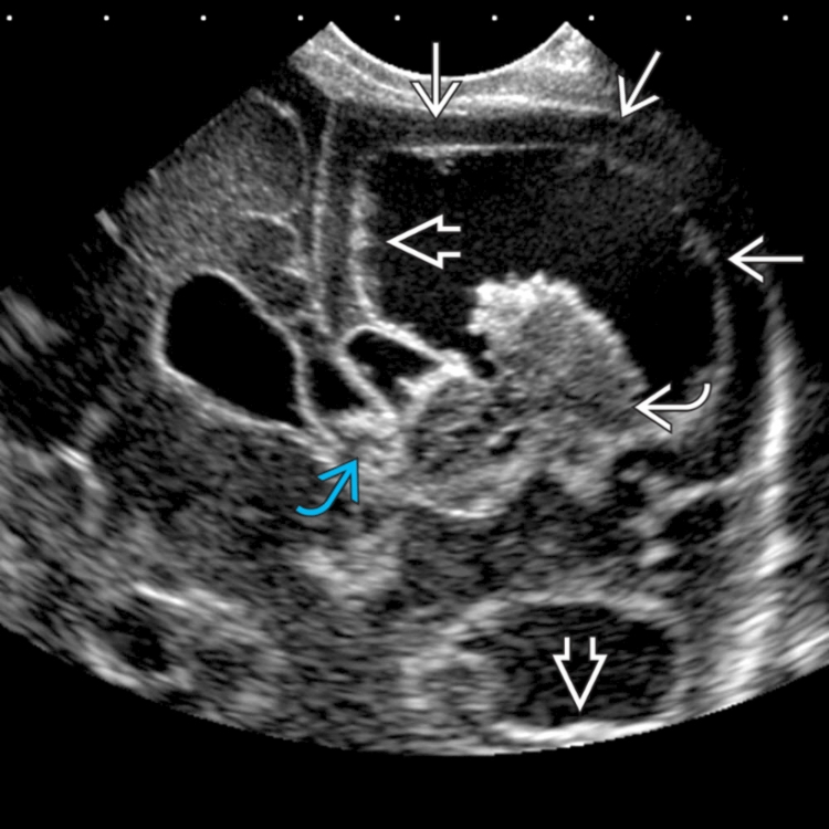 Germinal Matrix Hemorrhage | Radiology Key