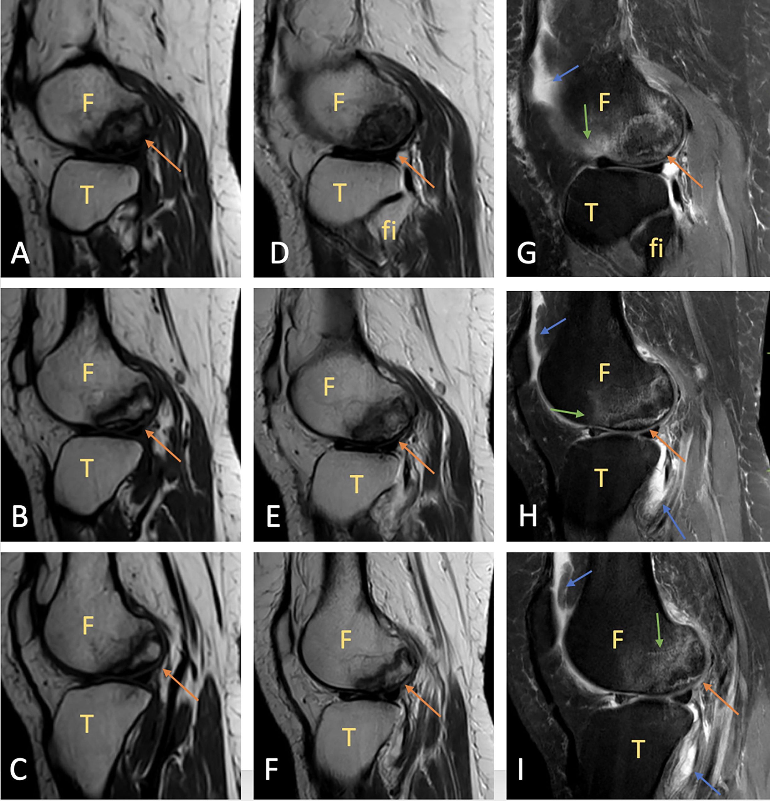 Avascular necrosis of lateral femoral condyle in a middle-aged woman ...
