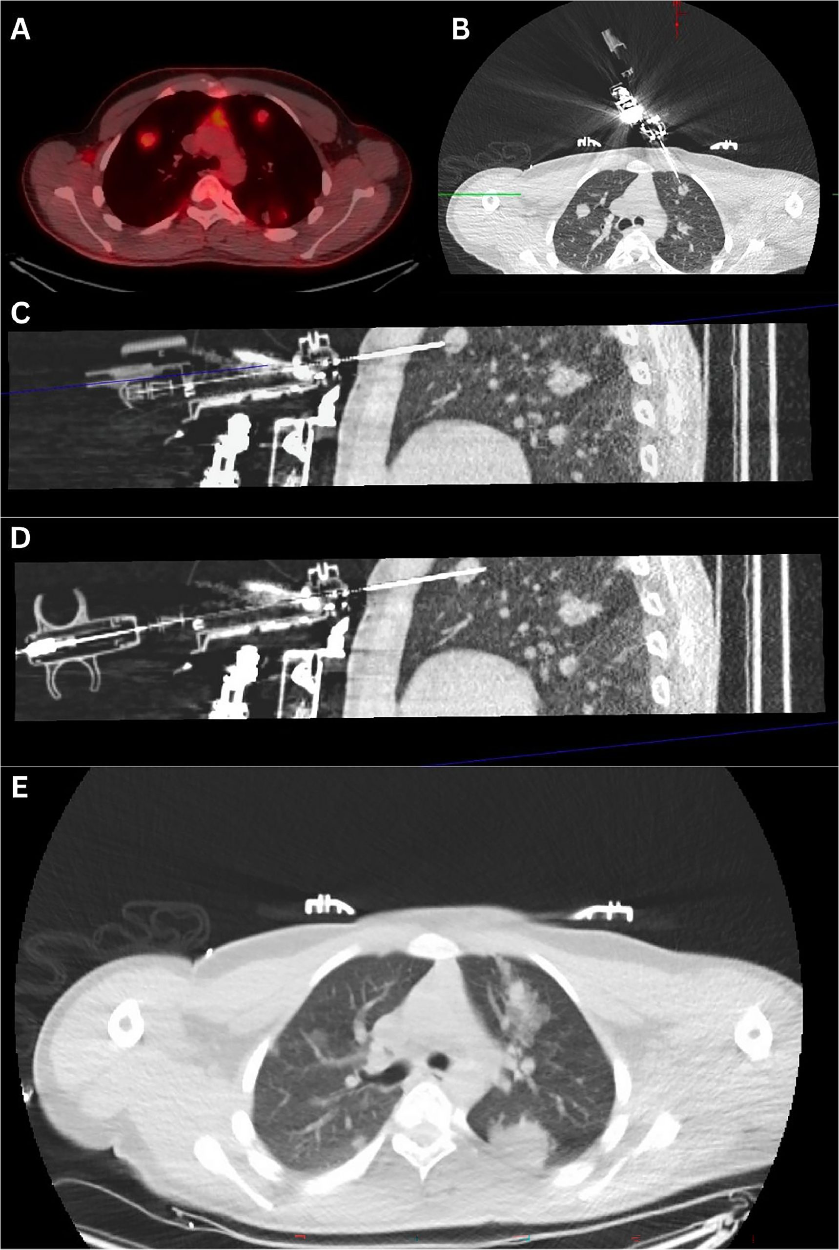 Image-Guided Percutaneous Robotic Interventions for Lung | Radiology Key