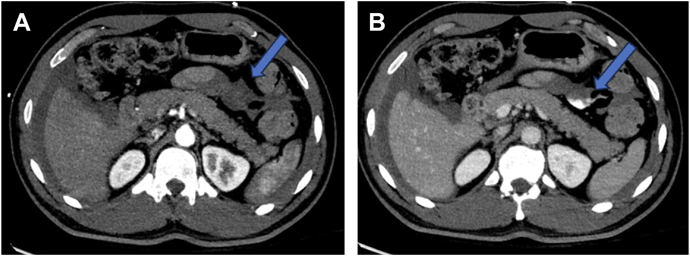 Imaging of Blunt Traumatic Bowel and Mesenteric Injuries | Radiology Key