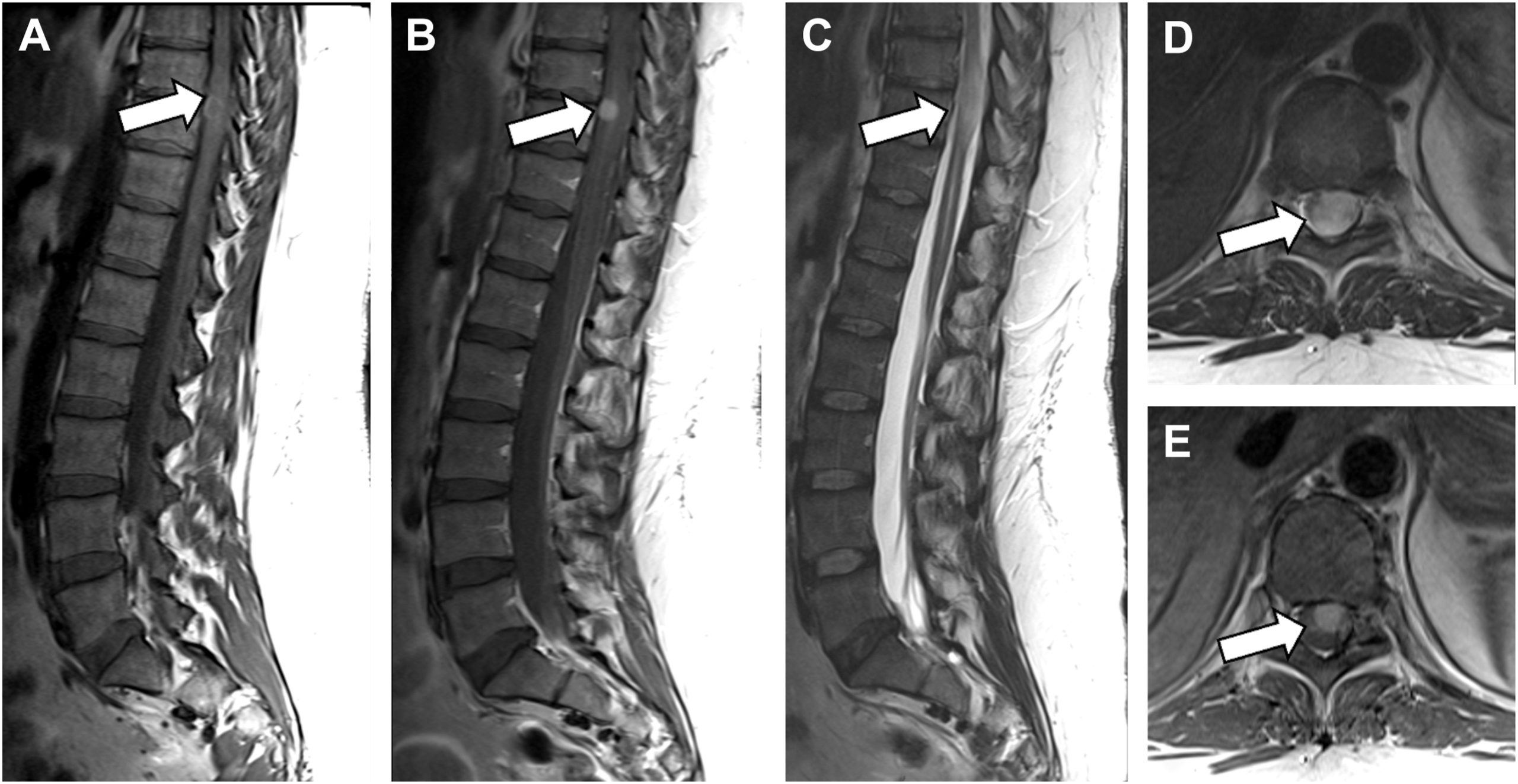 Intramedullary Tumor
