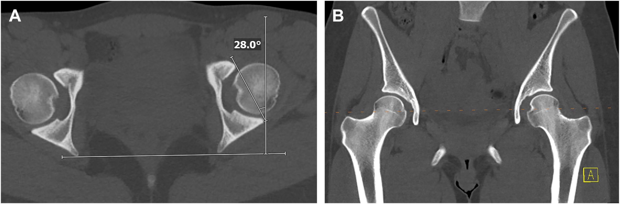 MR Imaging Evaluation of Hip Dysplasia in the Young Adult | Radiology Key