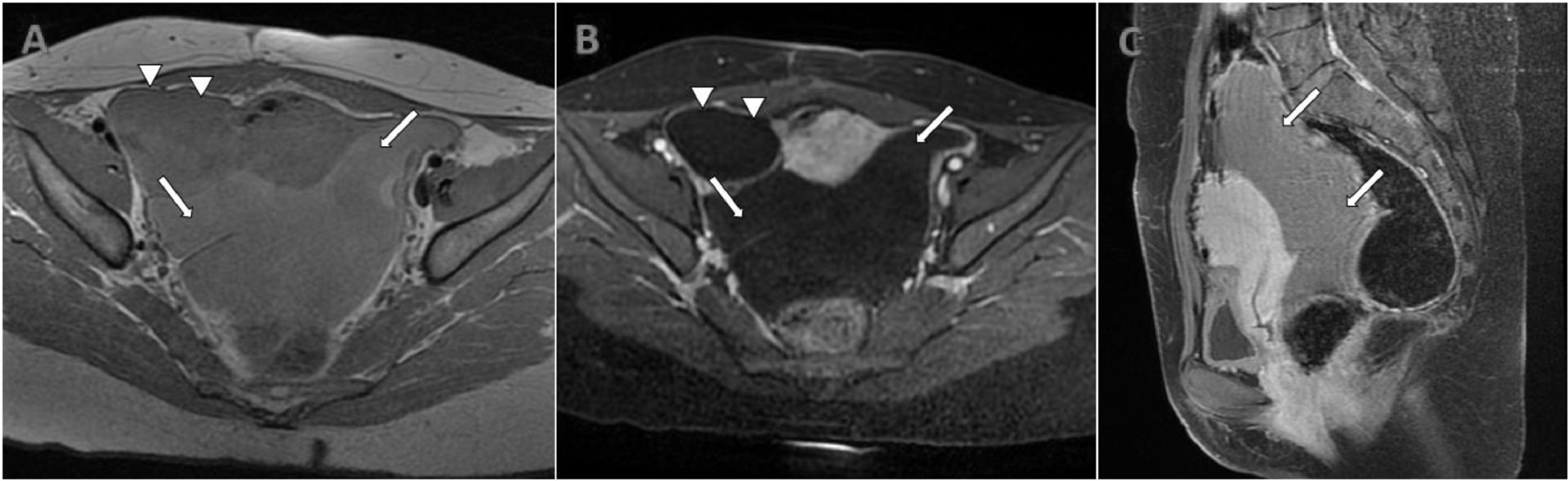 Uncovering a peritoneal inclusion cyst after surgery: A case report ...