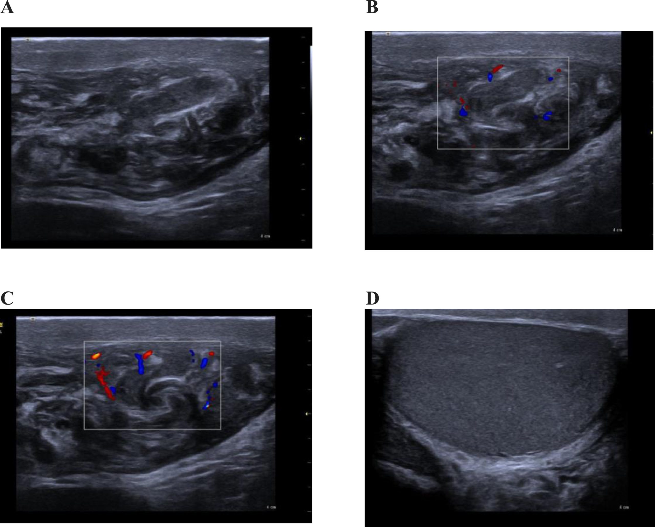 Rare case of left epididymo-orchitis complicated by pampiniform plexus ...