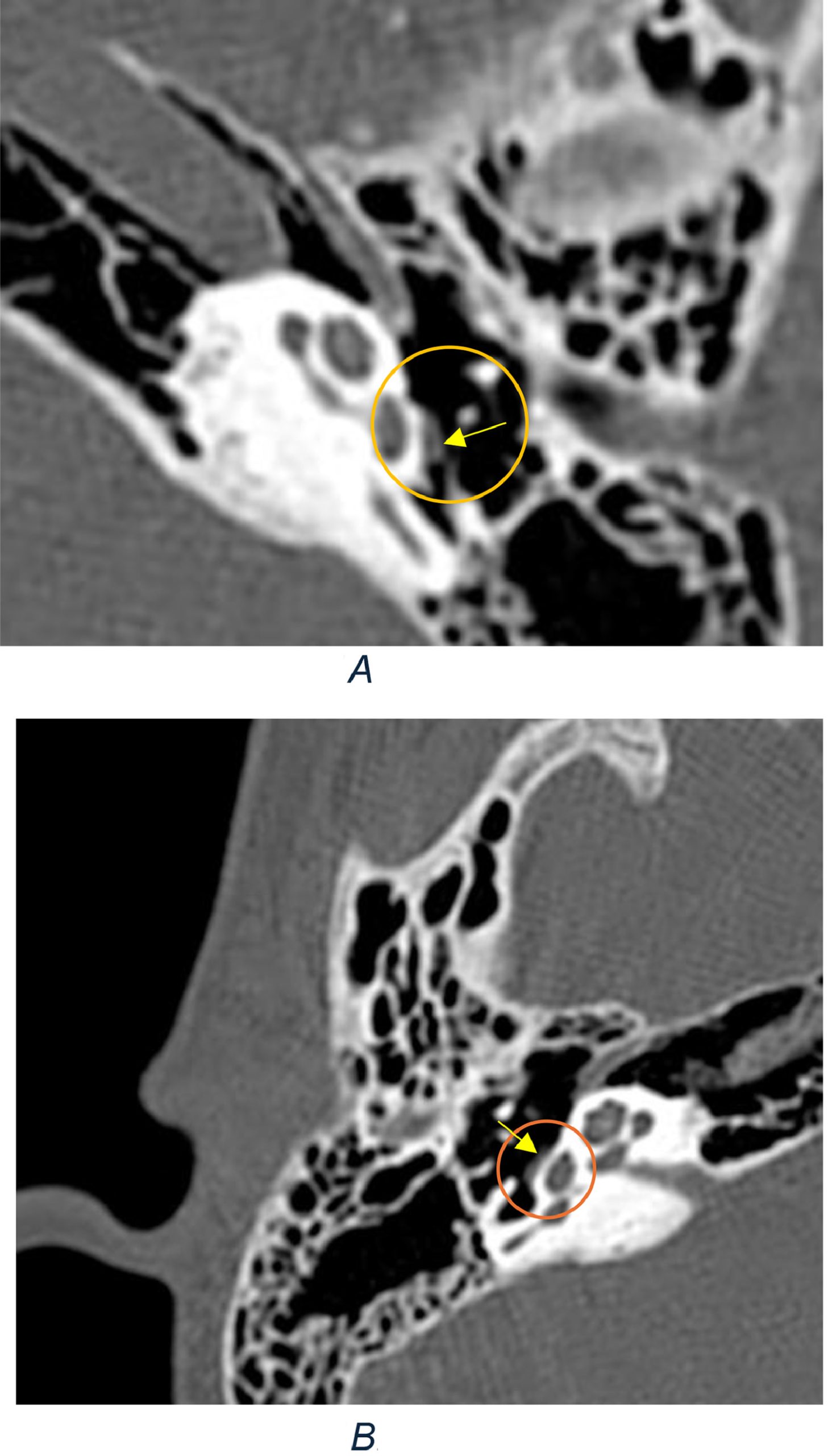 Rare case of aberrant course of facial nerve traversing above oval ...