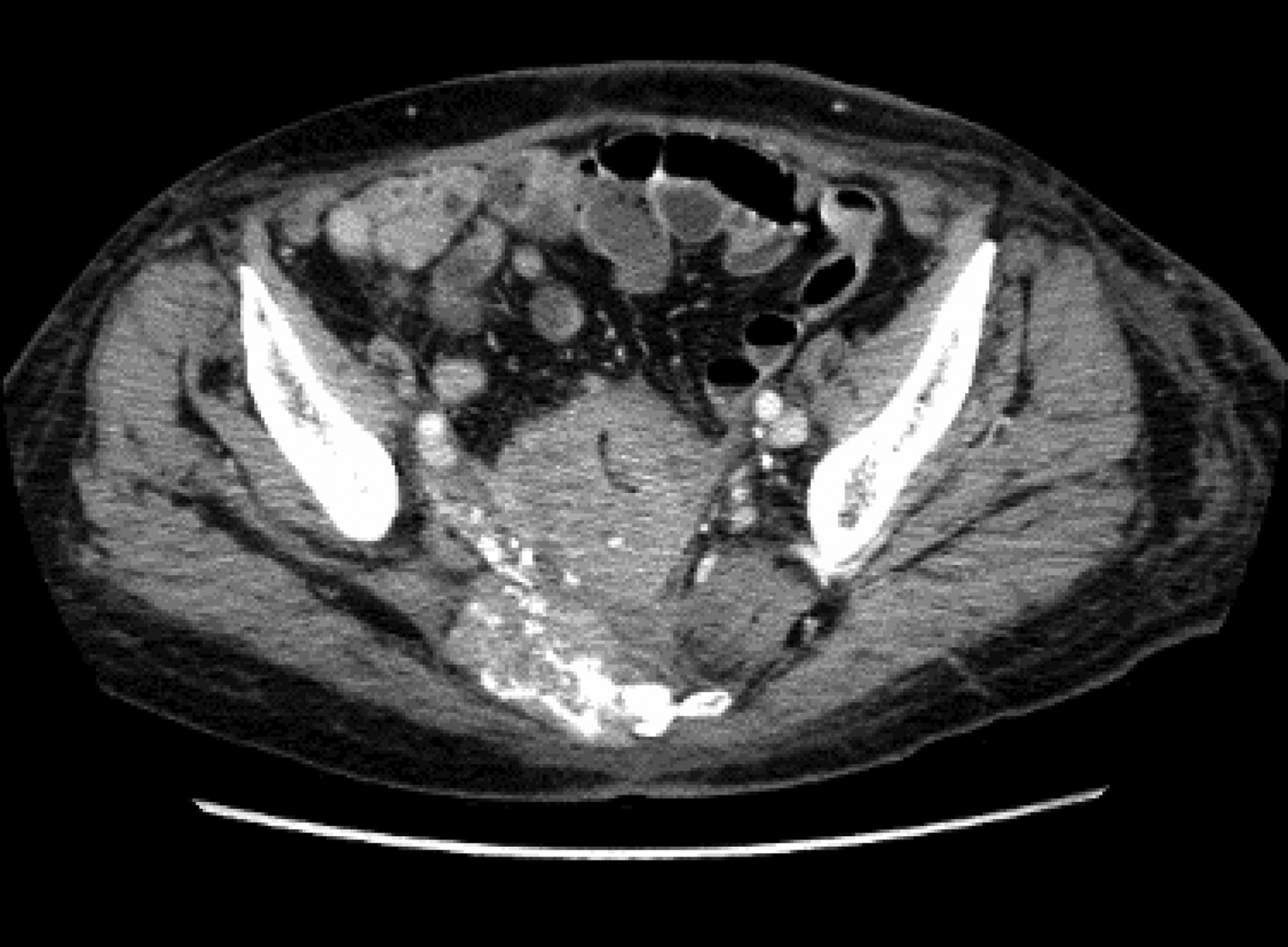 Percutaneous transabdominal drainage for pyometra: A case report ...