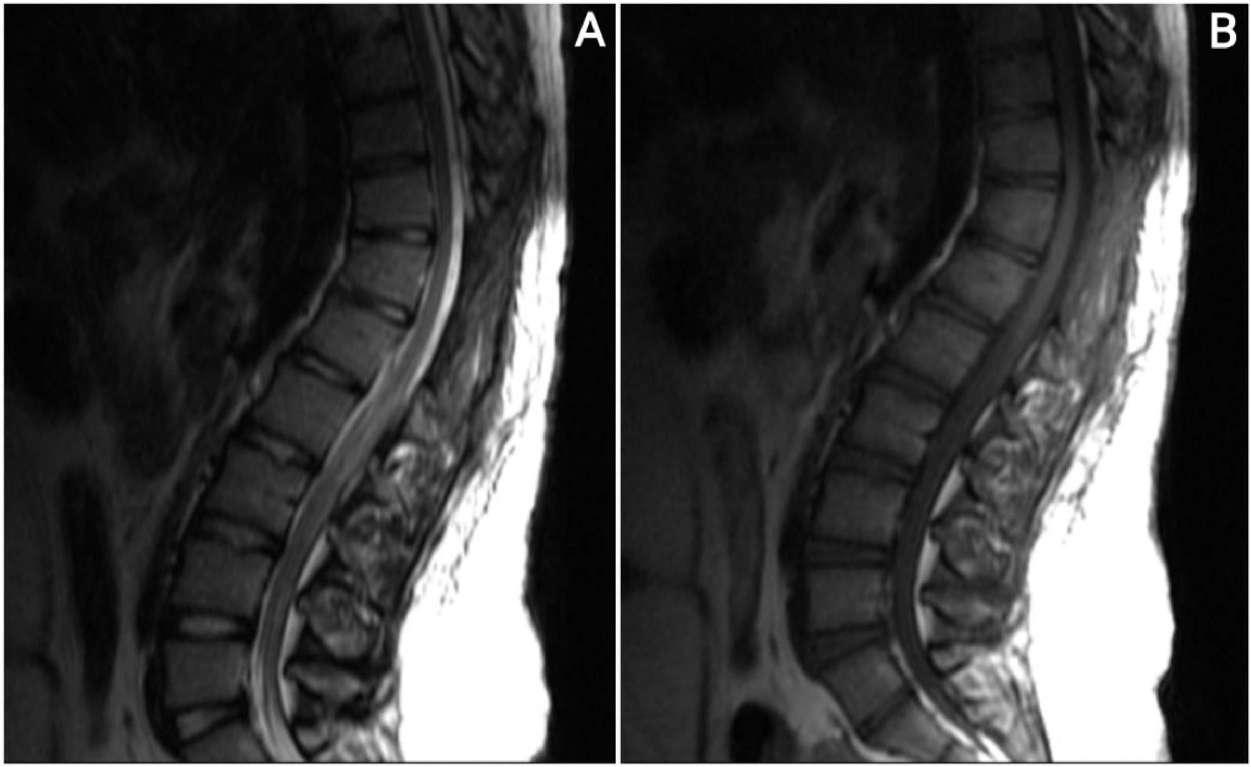 Unusual case of staphylococcus epidermidis-induced spinal epidural ...