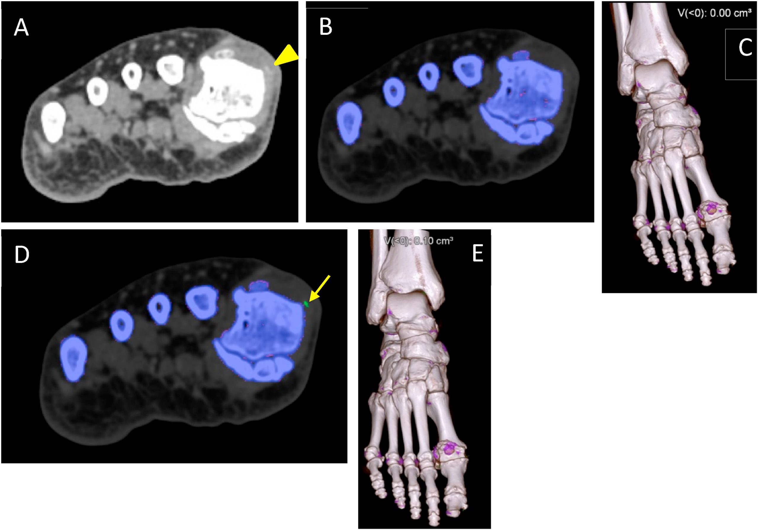 Dual energy CT for the diagnosis of gout: Evaluating the optimal ...