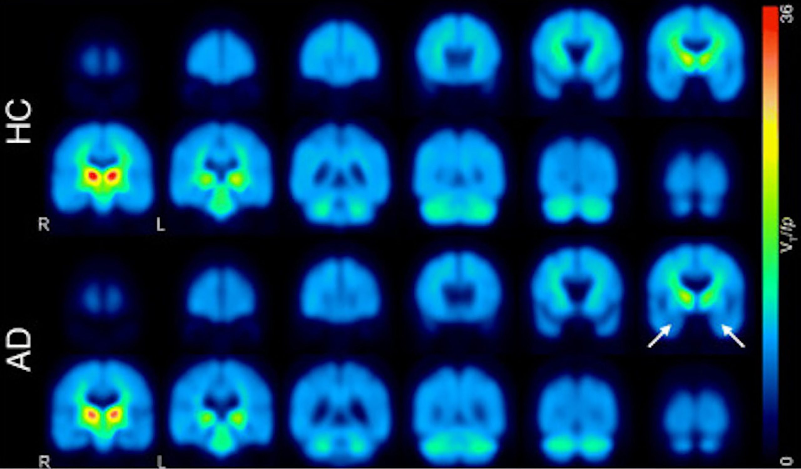 Clinical Applications of PET Imaging in Alzheimer’s Disease | Radiology Key