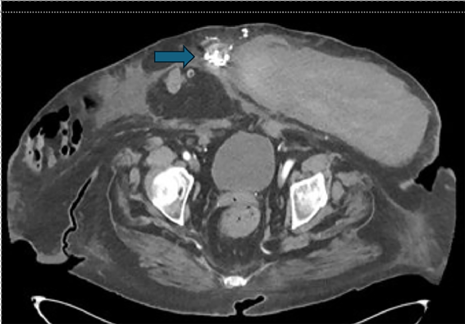 Inferior epigastric pseudoaneurysm and rectus sheath hematoma treated ...