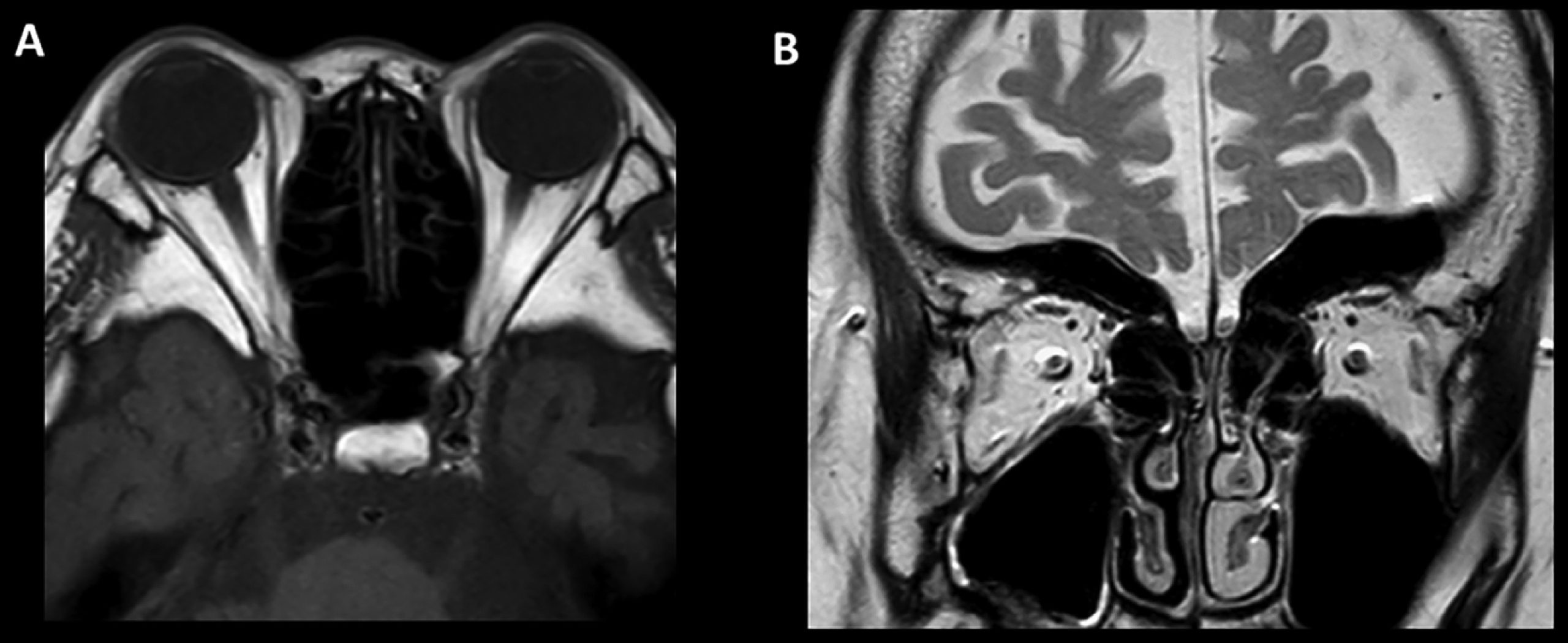 Kearns-Sayre syndrome with restricted diffusion in subcortical white ...