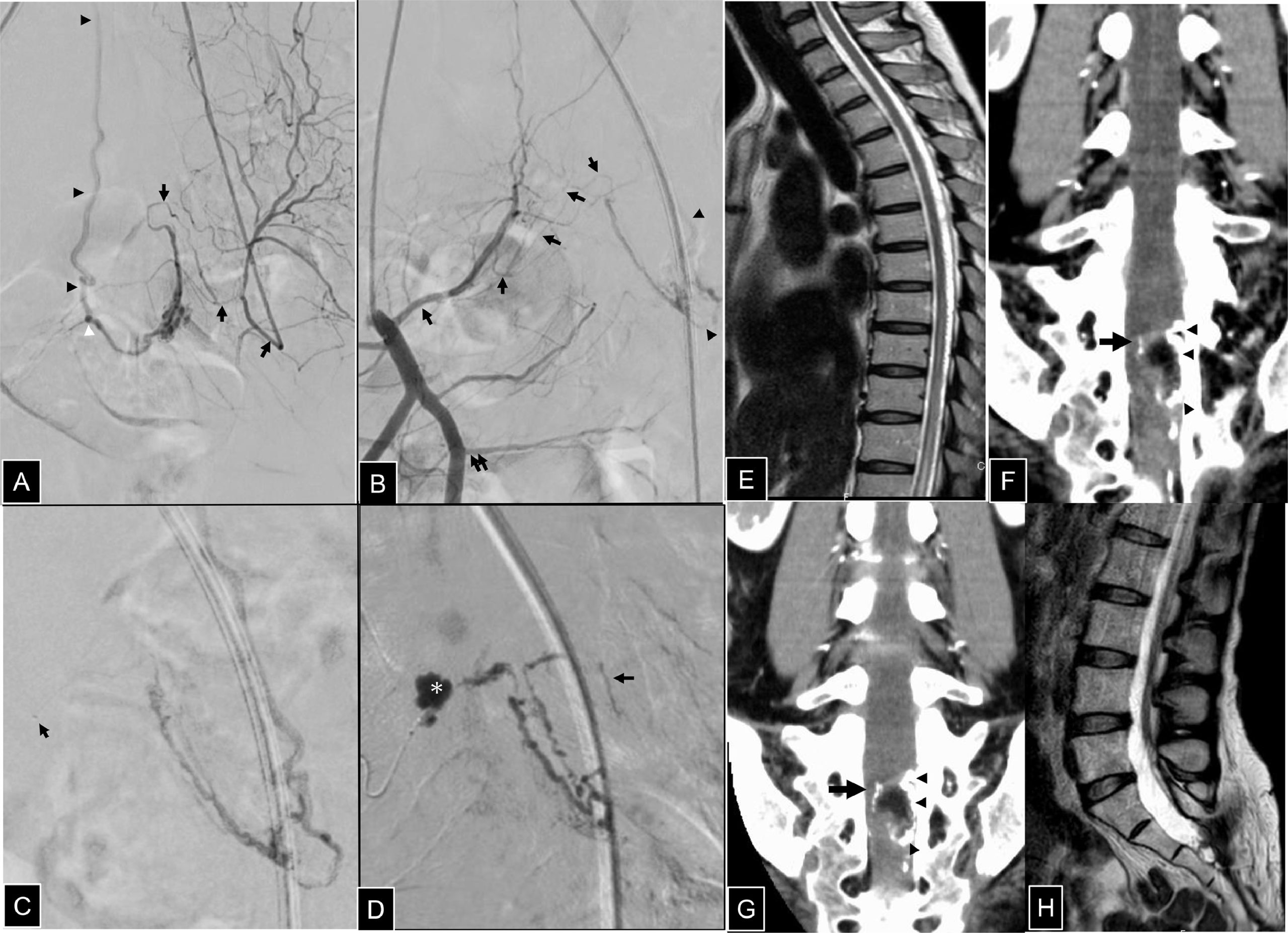 A case of spinal arteriovenous fistula complicated with congenital ...
