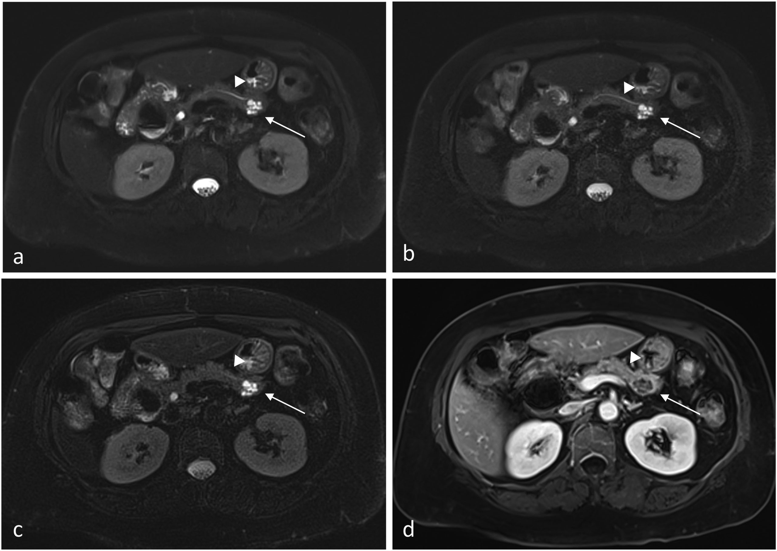 Feasibility of deep learning-reconstructed thin-slice single-breath ...