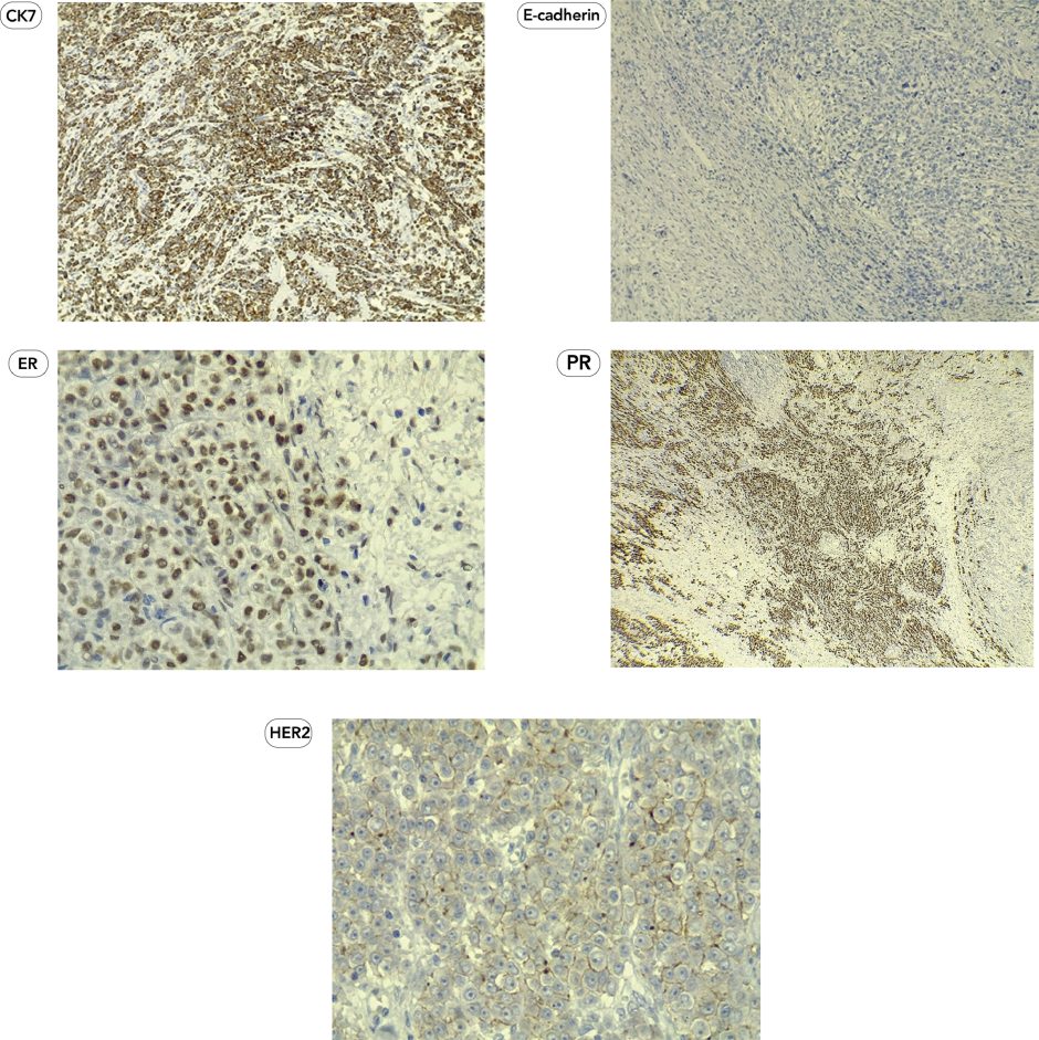 Uncovering a peritoneal inclusion cyst after surgery: A case report ...