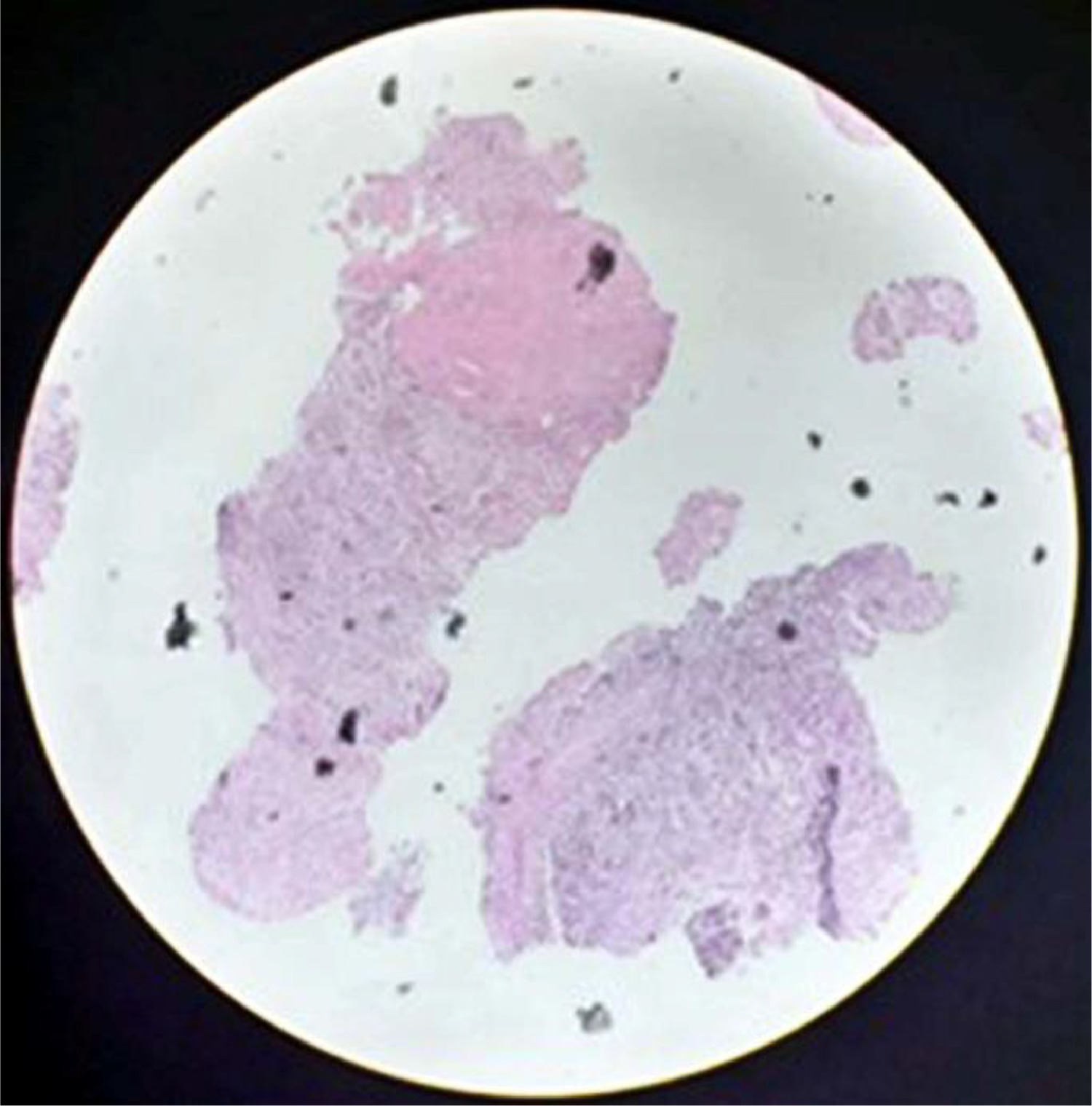 A rare case of gliosarcoma: Comprehensive radiological ...
