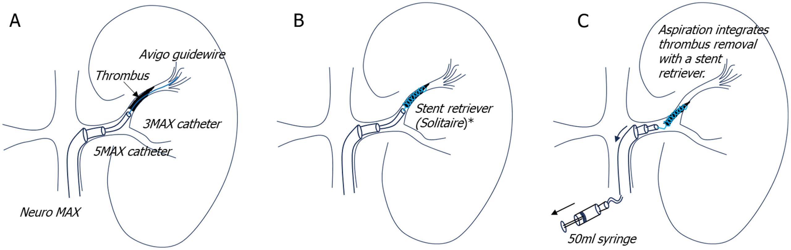 Successful use of Solumbra technique in renal artery thrombectomy: A ...
