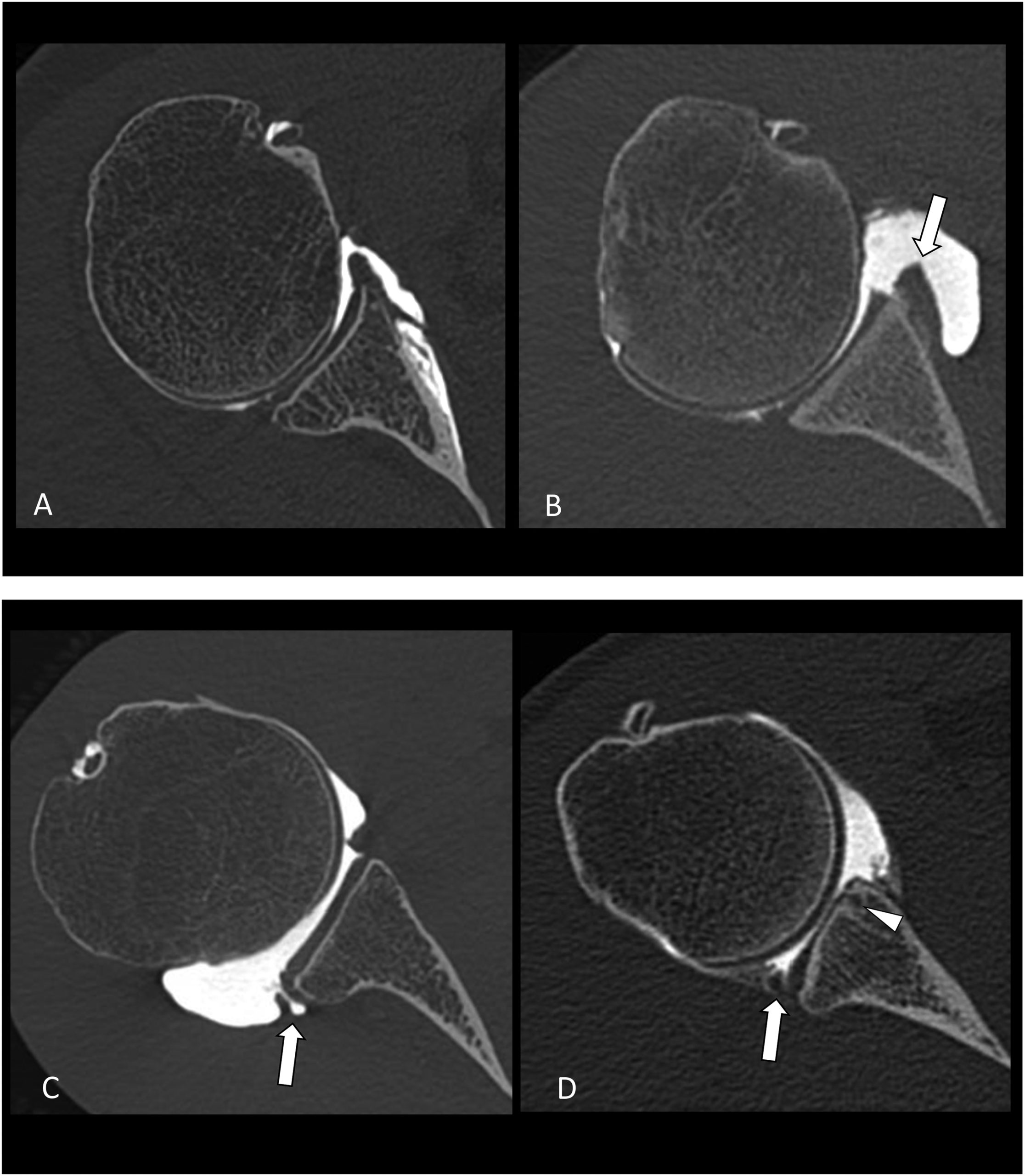 Glenoid morphology variation between patients with hypermobile shoulder ...