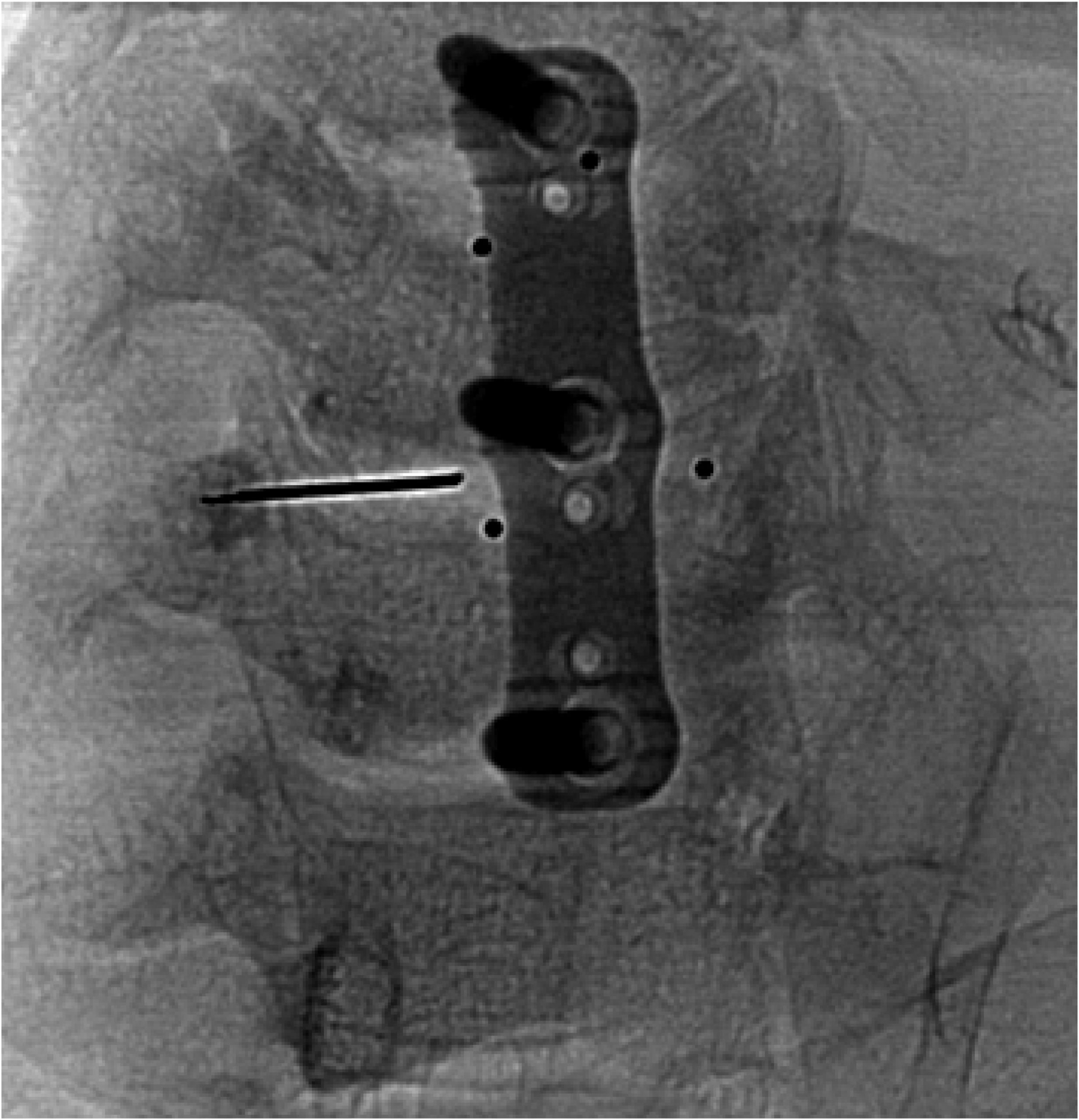 Epidural steroid injection technique | Radiology Key