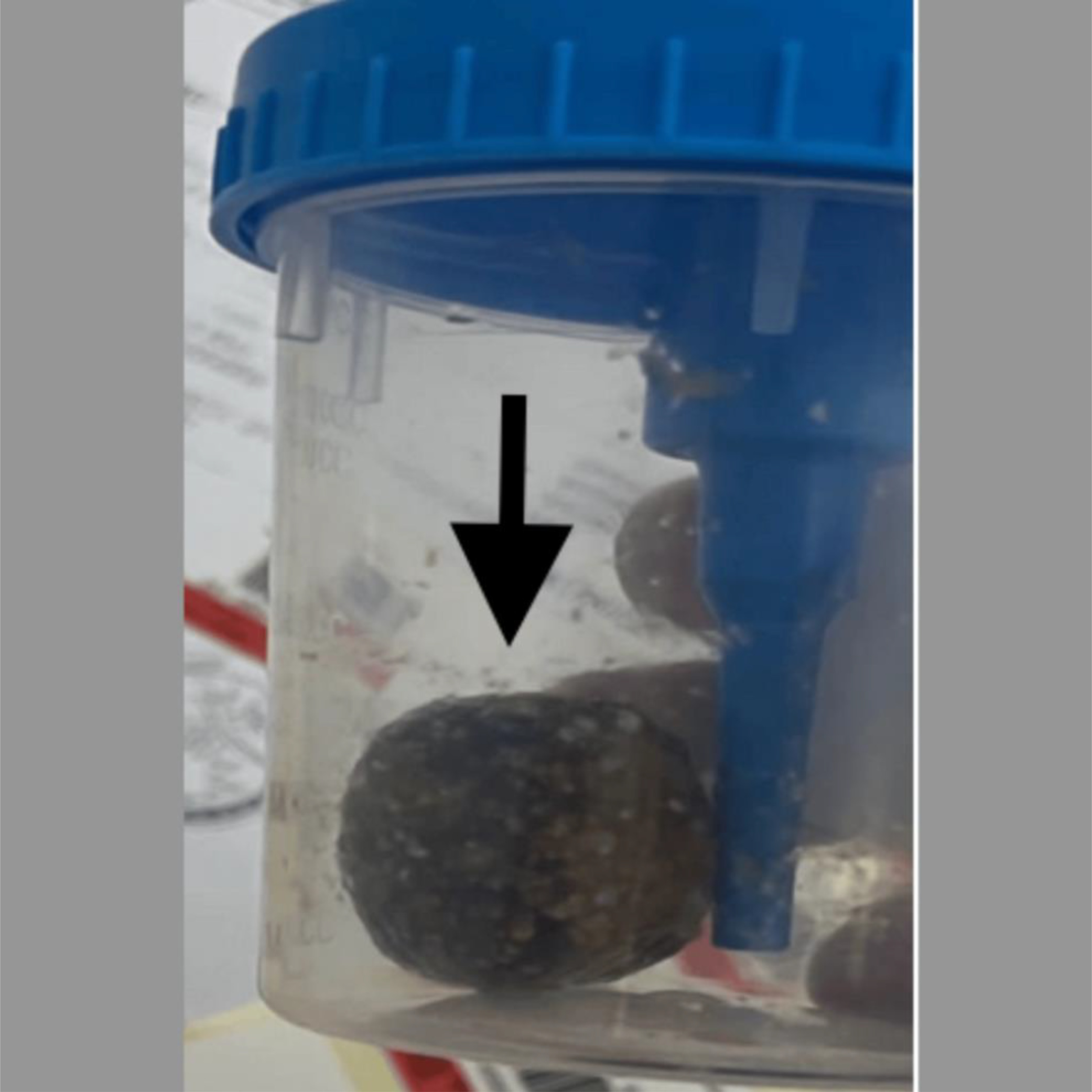 Radiolucent gallstone ileus causing proximal small bowel obstruction: A ...