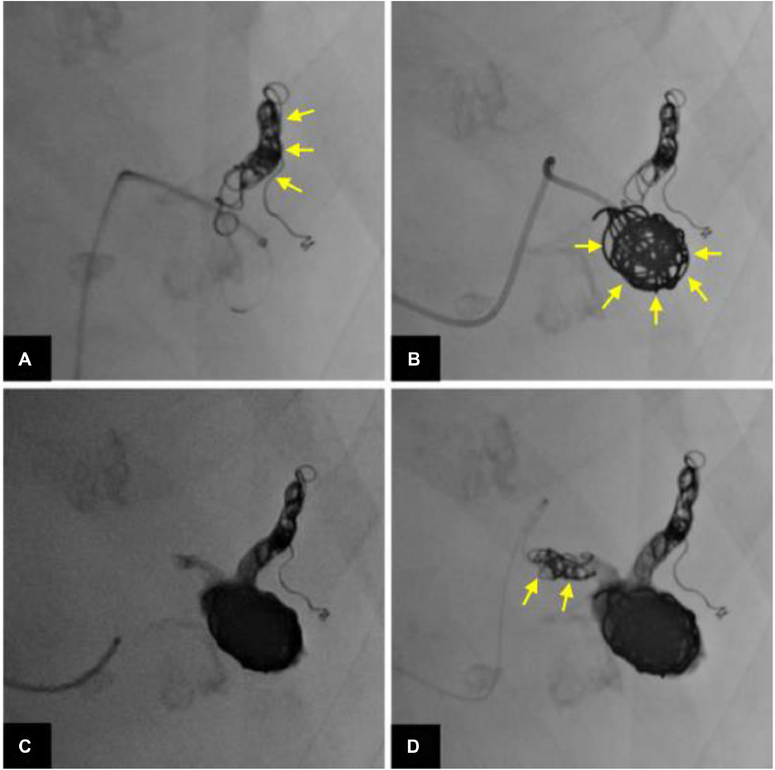 Embolization of splenic artery aneurysms using coils and n‑butyl 2 ...