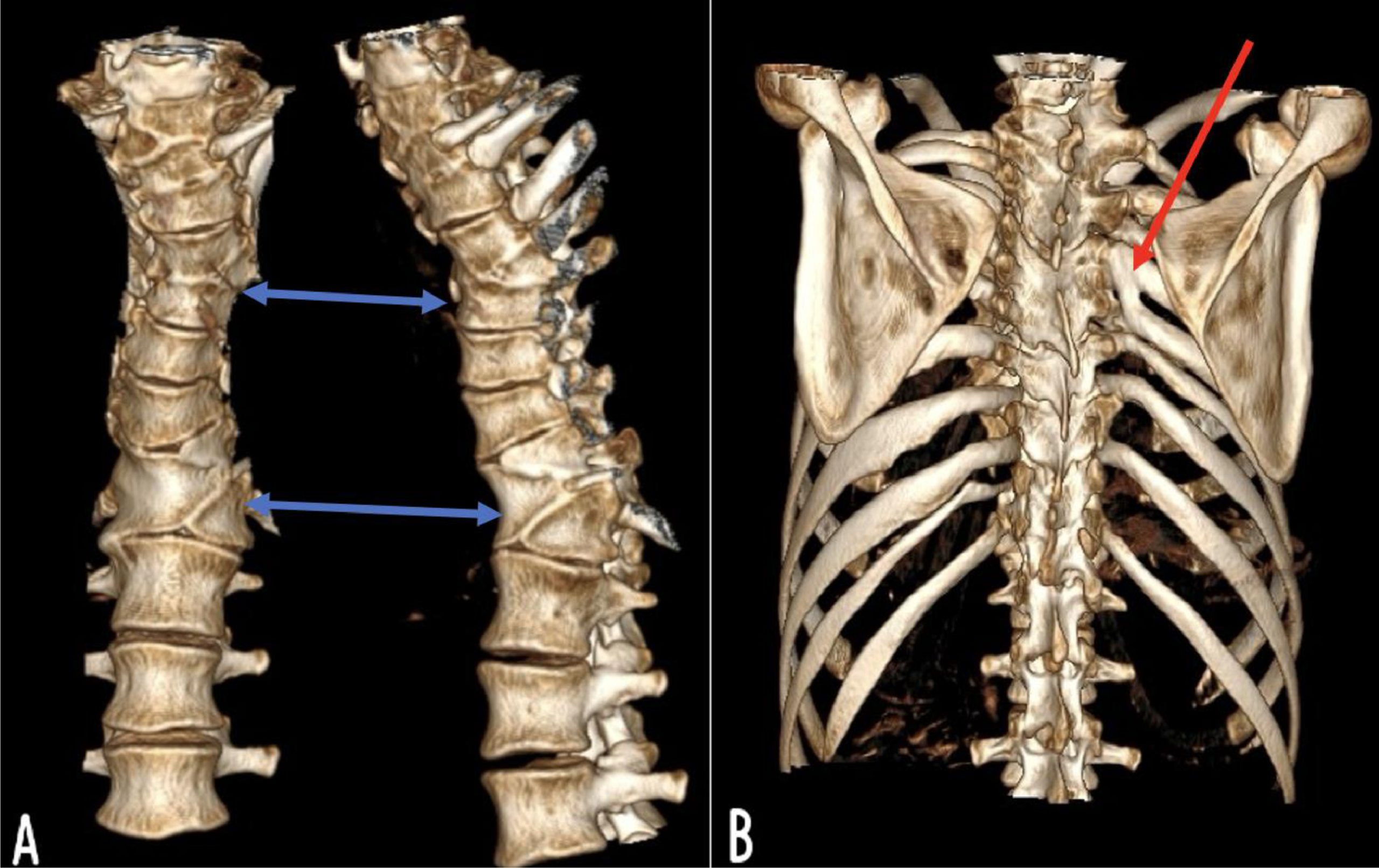 Long overlooked: Adult VACTERL association unmasked by a large patent ...