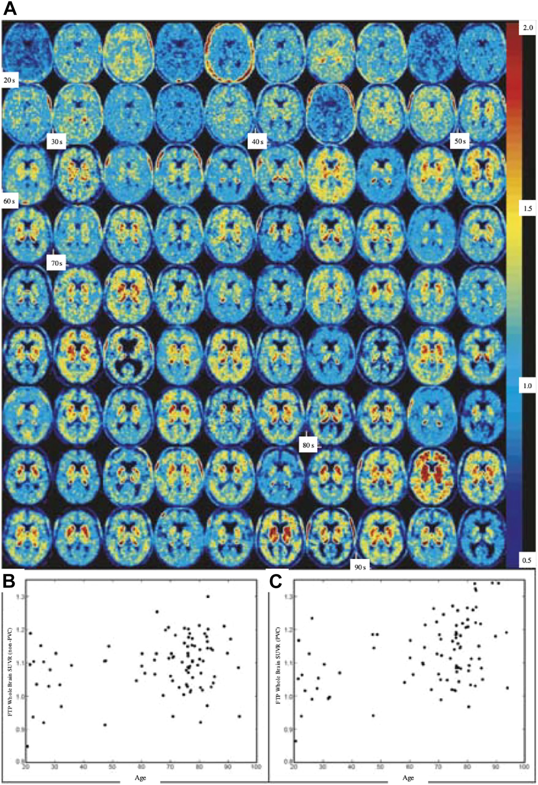 Structural and Molecular Imaging of Aging Brain | Radiology Key