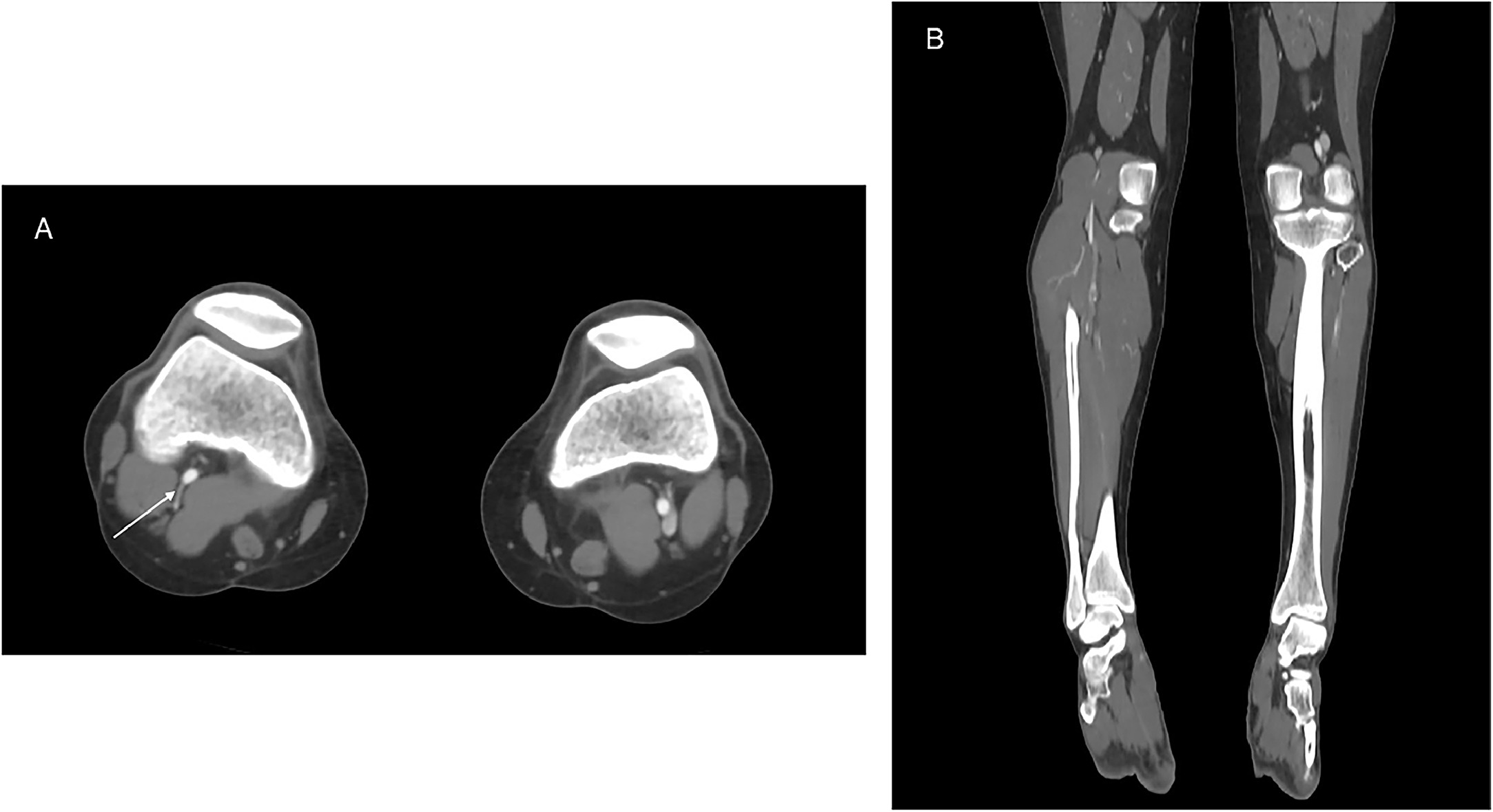 Venous Compressive Disorders | Radiology Key