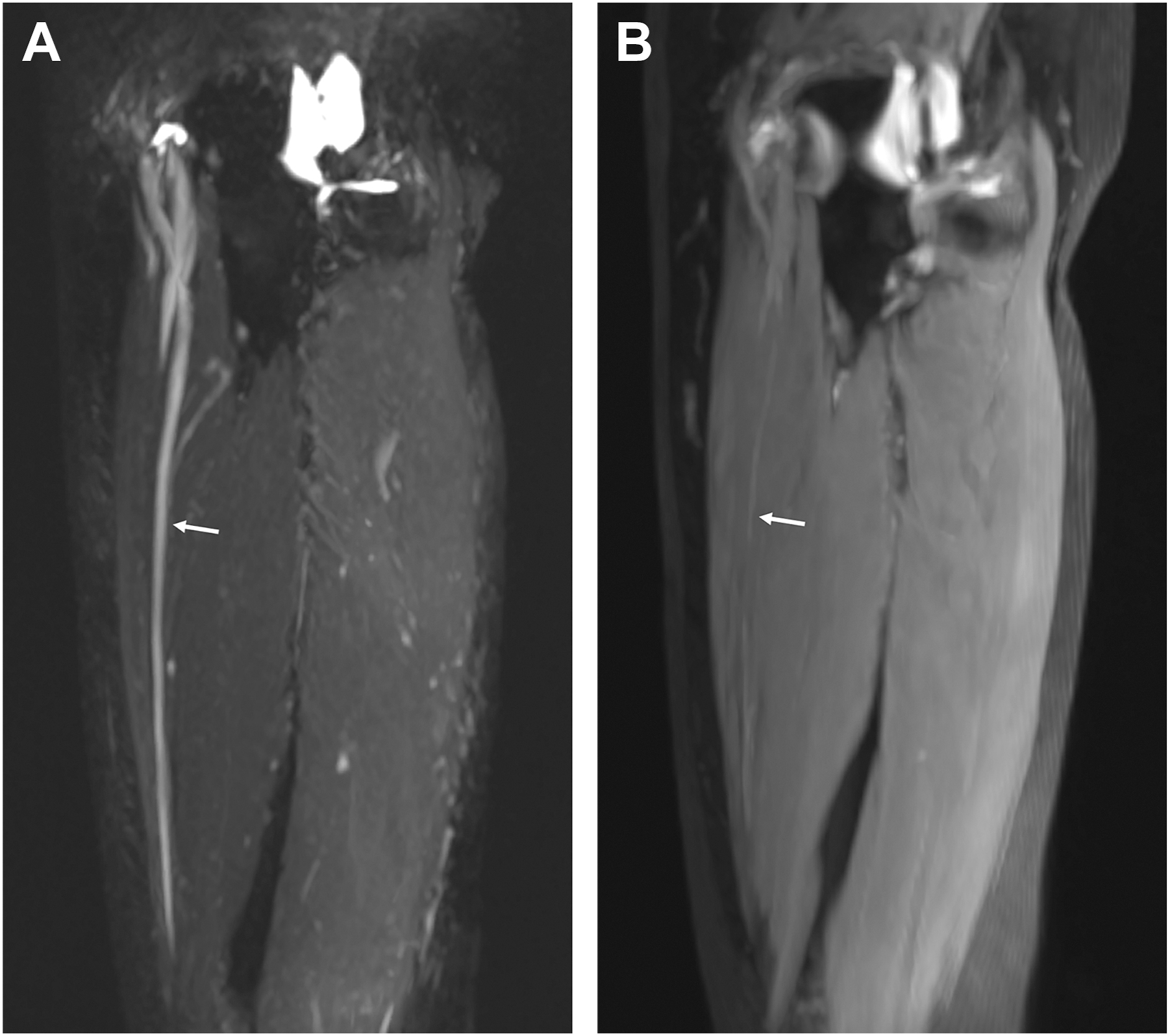 Plexus and Peripheral Nerve MR Imaging: Advances and Applications ...