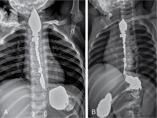 Upper gastrointestinal abnormalities (typically seen in infants and ...