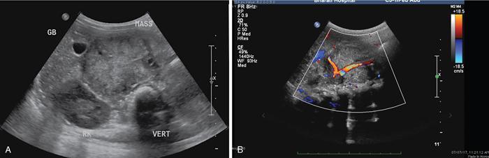 Paediatric pancreatic pathologies | Radiology Key
