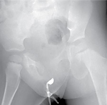 Bladder and urethral abnormalities in children | Radiology Key