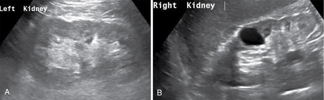 Glomerular diseases: An insight into imaging of nephritic and nephrotic ...